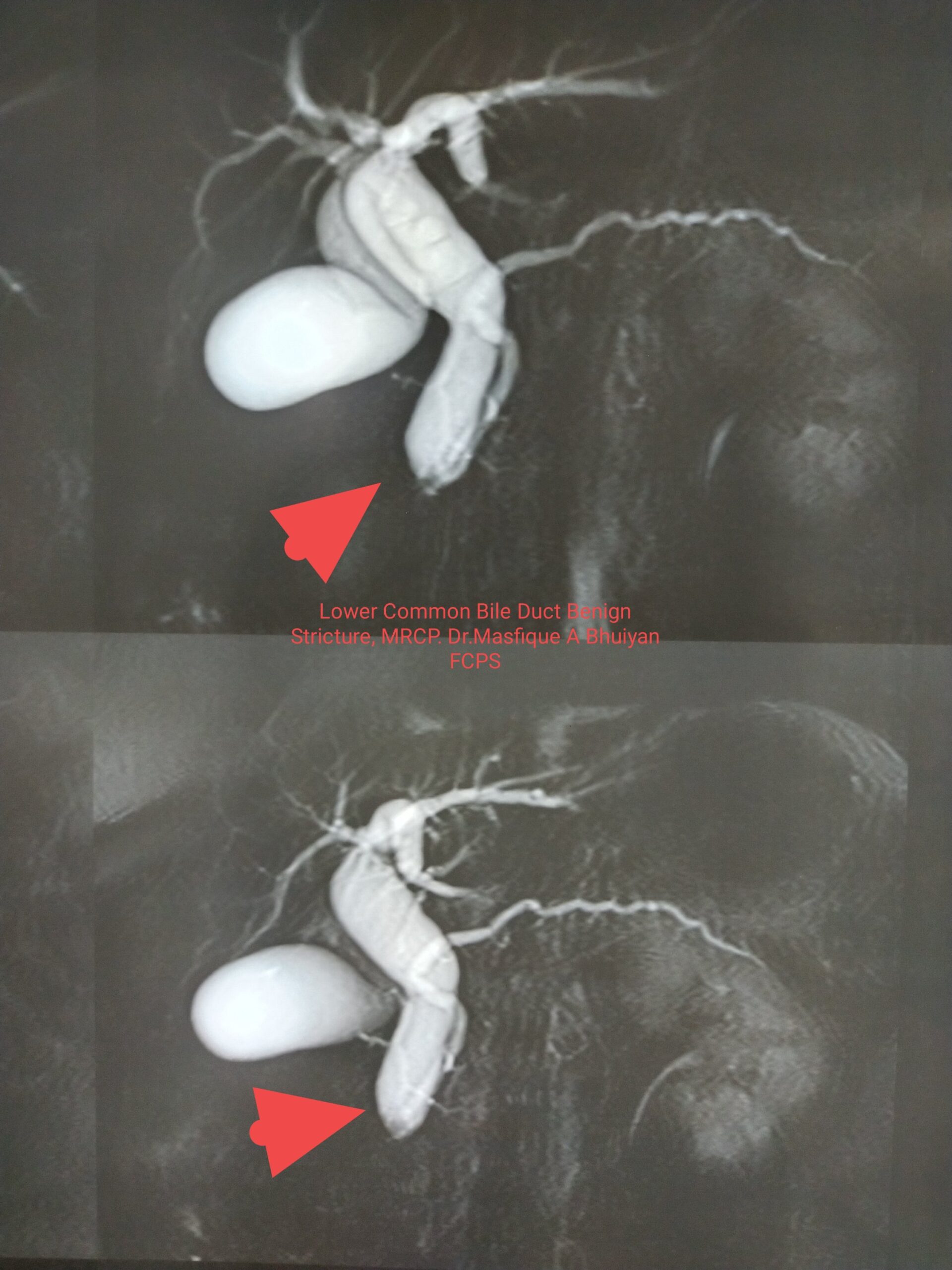 Lower Common Bile Duct Benign Stricture, MRCP. Dr.Masfique A Bhuiyan ...